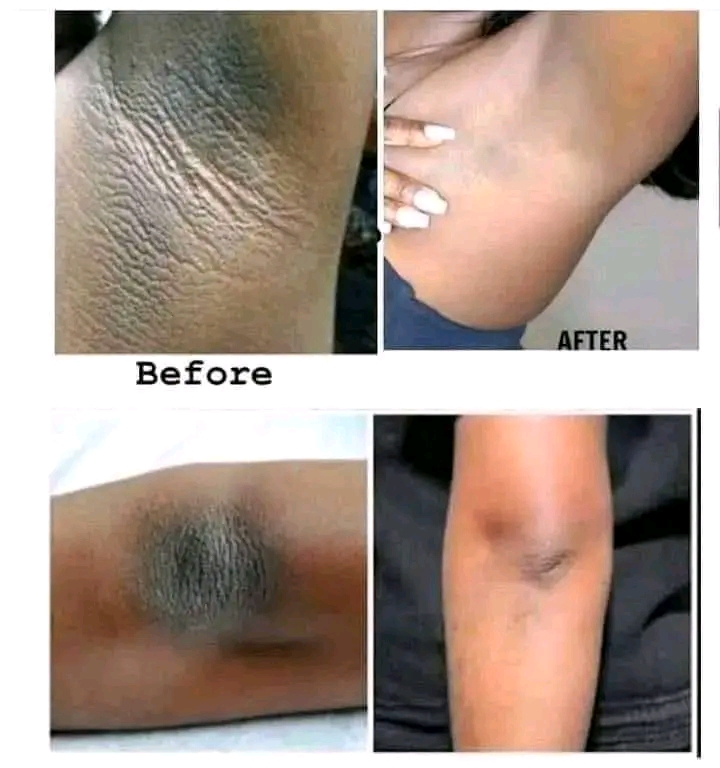 How to lighten your dark armpit - Welcome to Oluwakemicrafts